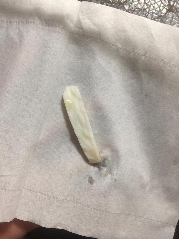 Thế giới bây giờ đảo điên thật rồi: Tưởng lòi sụn sau nâng mũi, tháo ra ...