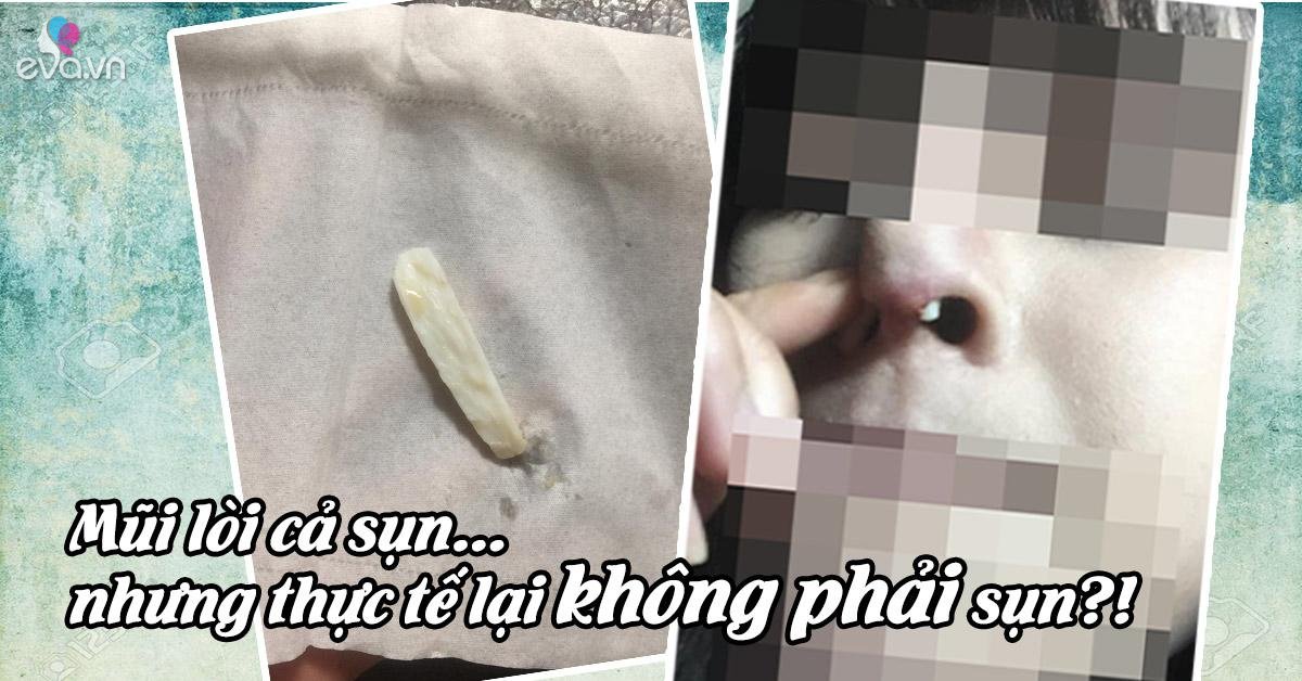 Thế giới bây giờ đảo điên thật rồi: Tưởng lòi sụn sau nâng mũi, tháo ra ...