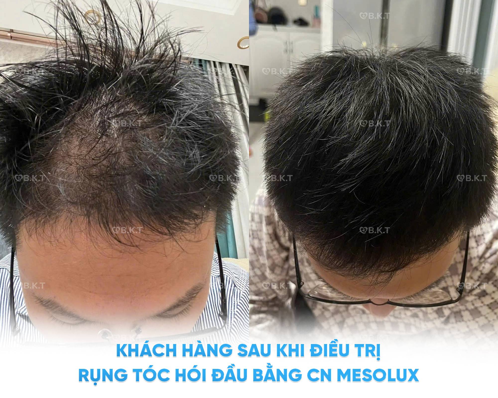 Bác sĩ Bùi Kiều Trang: Công nghệ Mesolux là "cứu tinh” cho mái tóc thưa ...