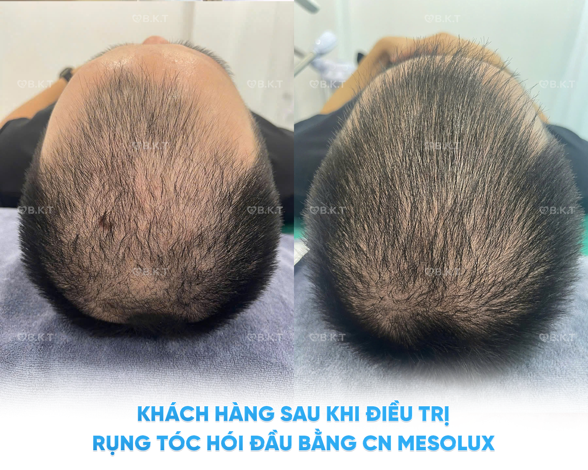 Bác sĩ Bùi Kiều Trang: Công nghệ Mesolux là "cứu tinh” cho mái tóc thưa ...