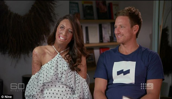 Chuyện mang thai của người mẫu Turia Pitt mang khuôn mặt biến dạng với ...