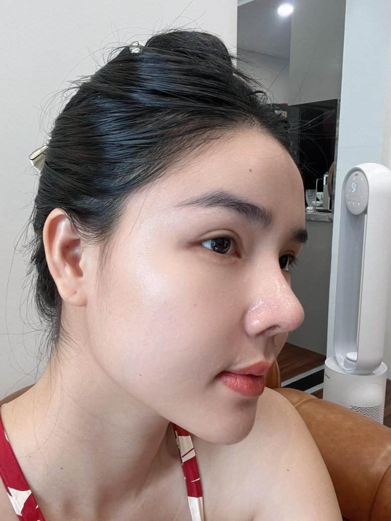 Vợ Mạc Hồng Quân hé lộ diện mạo giai đoạn thẩm mỹ hỏng, giờ phải chi 90 ...