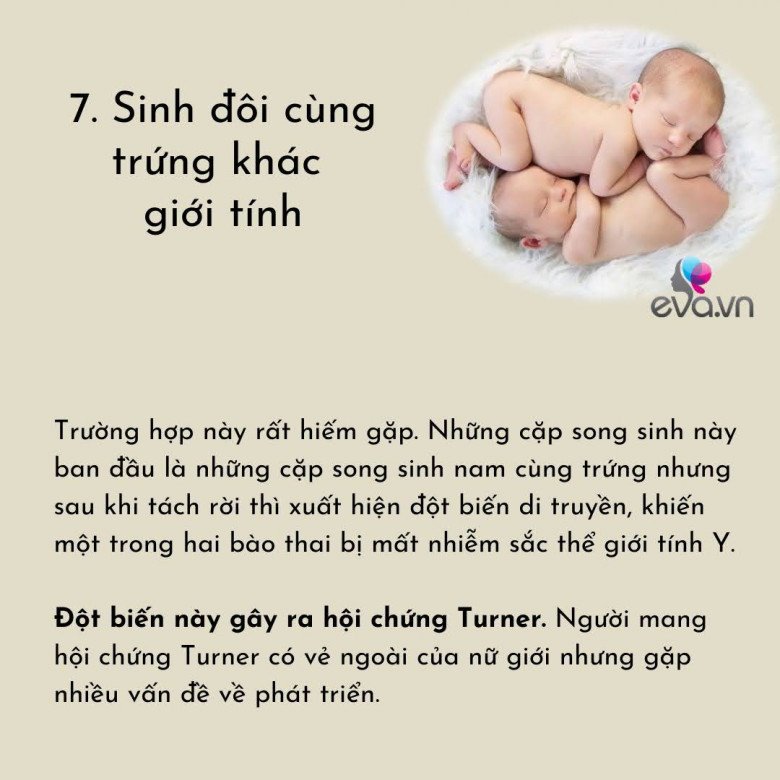 Không phải trẻ sinh đôi nào cũng giống nhau bởi có 7 kiểu sinh đôi mà ...