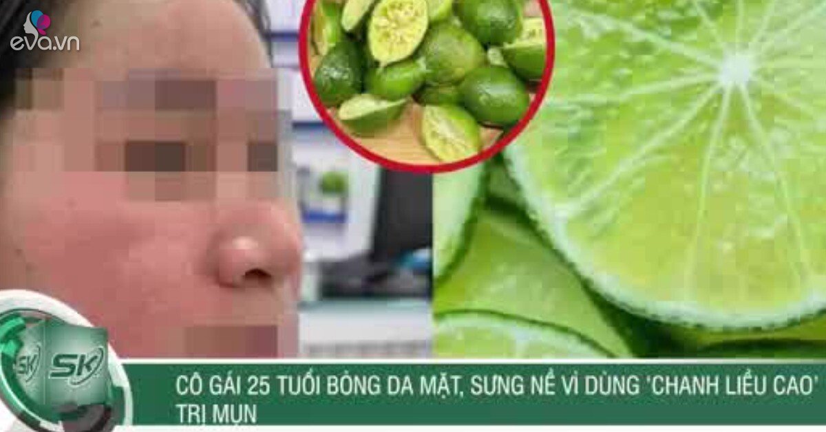 Cô gái 25 tuổi bỏng da mặt, sưng nề vì dùng 'chanh liều cao' trị mụn
