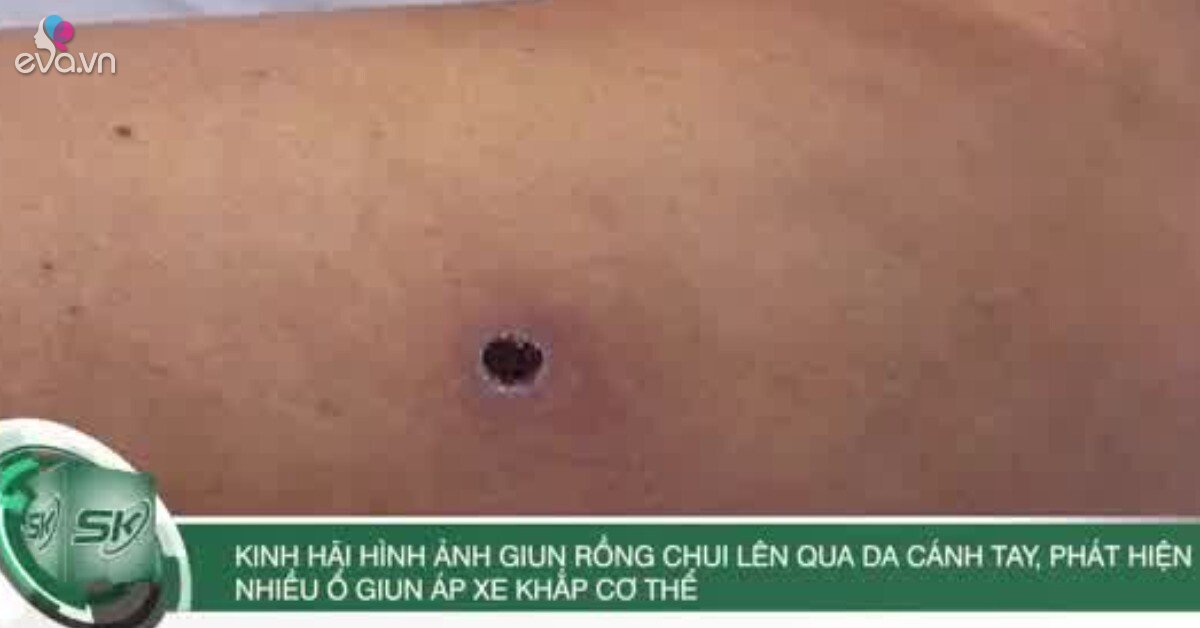 Kinh hãi hình ảnh giun rồng chui lên qua da, phát hiện nhiều ổ giun áp ...