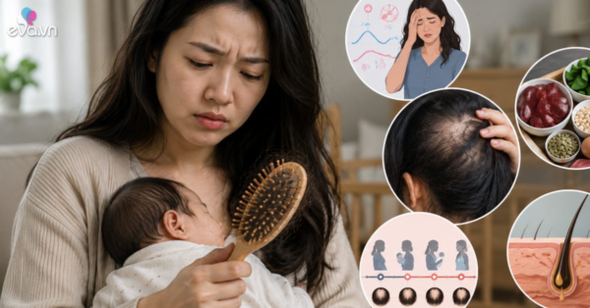 Rụng tóc sau sinh kéo dài: Khi nào không còn bình thường?