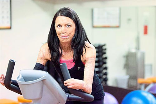 Xúc động người mẫu được yêu hơn dù biến dạng mặt vì bỏng