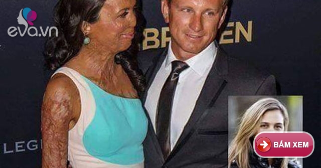 Xúc động người mẫu được yêu hơn dù biến dạng mặt vì bỏng