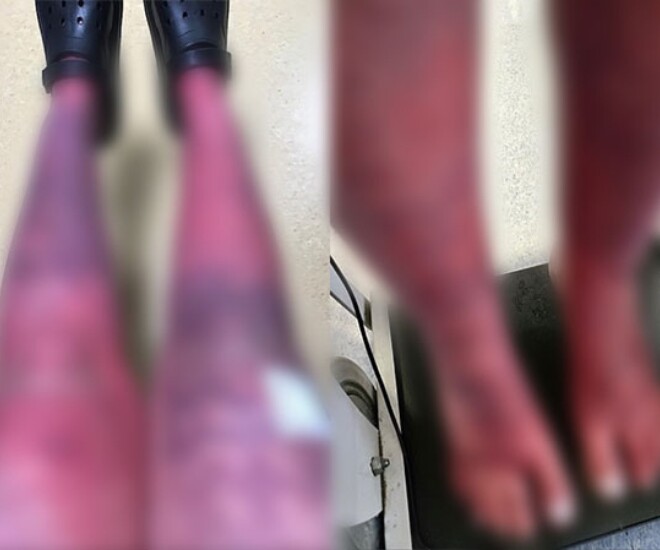 Cơ thể sản phụ phồng rộp, phải ngồi xe lăn sau sinh vì mắc bệnh hiếm ...